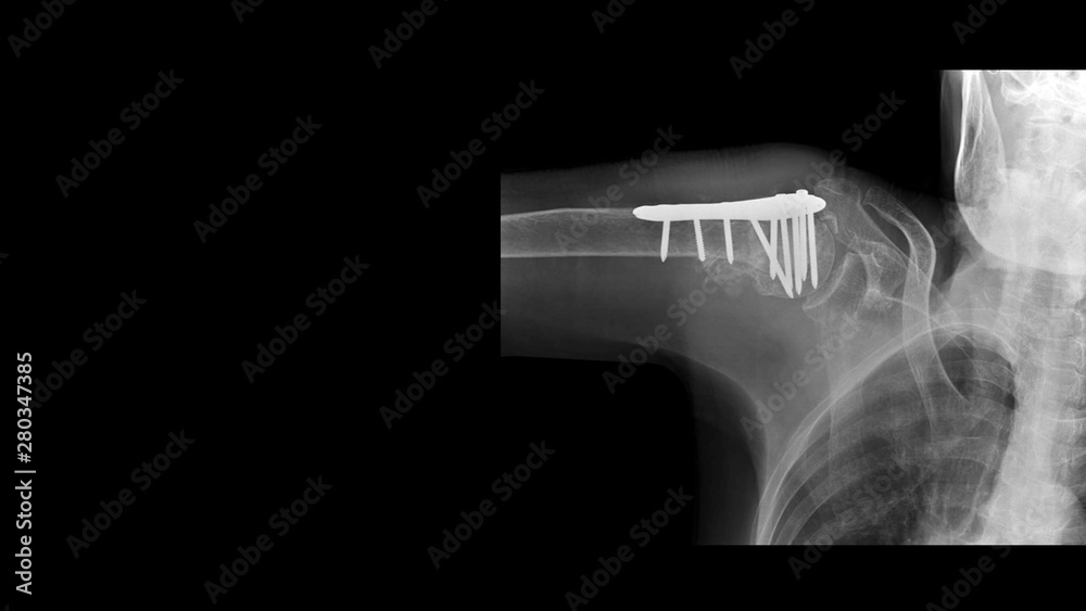 Film x ray shoulder radiograph show shoulder bone broken (neck of ...