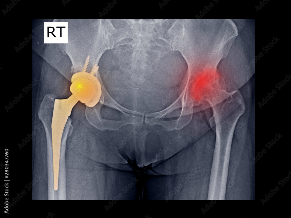 Film X ray hip radiograph showing bilateral developmental dysplasia of ...