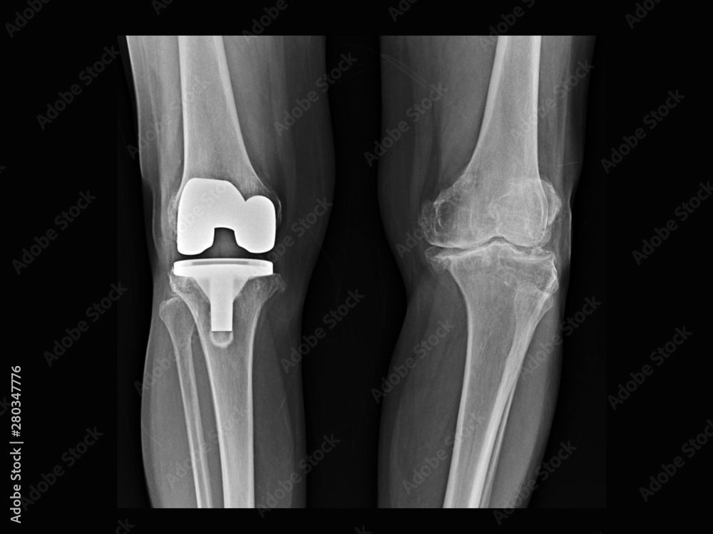 film X-ray knee radiograph showing bilateral osteoarthritis disease (OA ...
