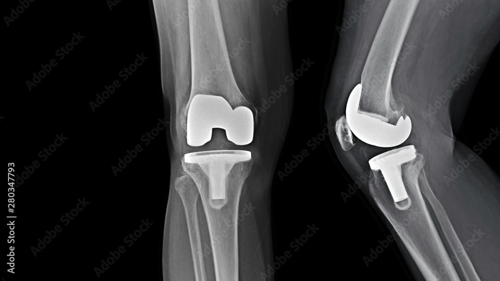 Film X-ray knee radiograph showing degenerative osteoarthritis (OA knee ...