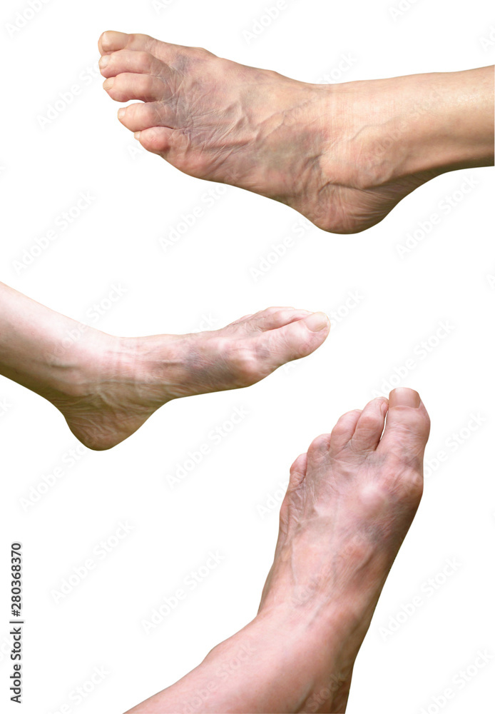 Bruised feet of an elderly woman. Hematoma, large, blue foot. Trauma of ...