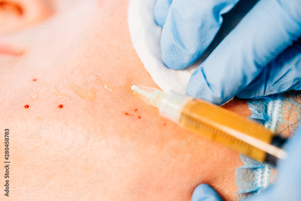 Plasma lifting - Injections of the obtained preparation into problem ...