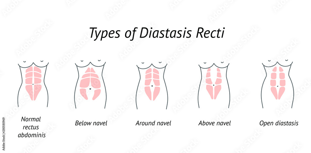 Different types of Diastasis Recti. Woman anatomy. Vector illustration ...