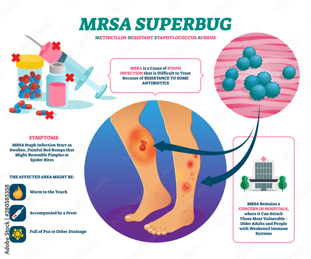 MRSA super bug vector illustration. Labeled staph infection explain ...