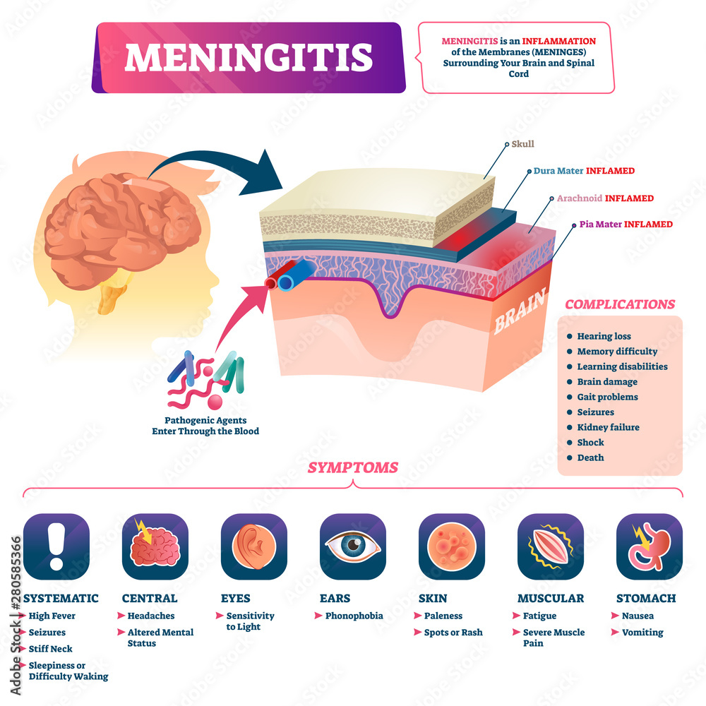Meningitis vector illustration. Labeled brain membrane inflammation ...