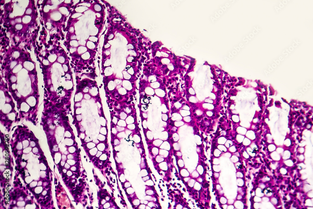 Bacillary dysentery, light micrograph, photo under microscope showing ...
