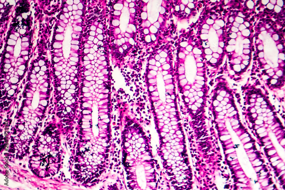 Bacillary dysentery, light micrograph, photo under microscope showing ...