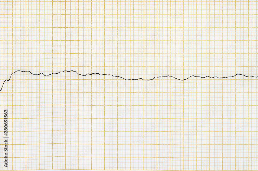 Emergency cardiology. ECG tape with ventricular fibrillation Stock ...