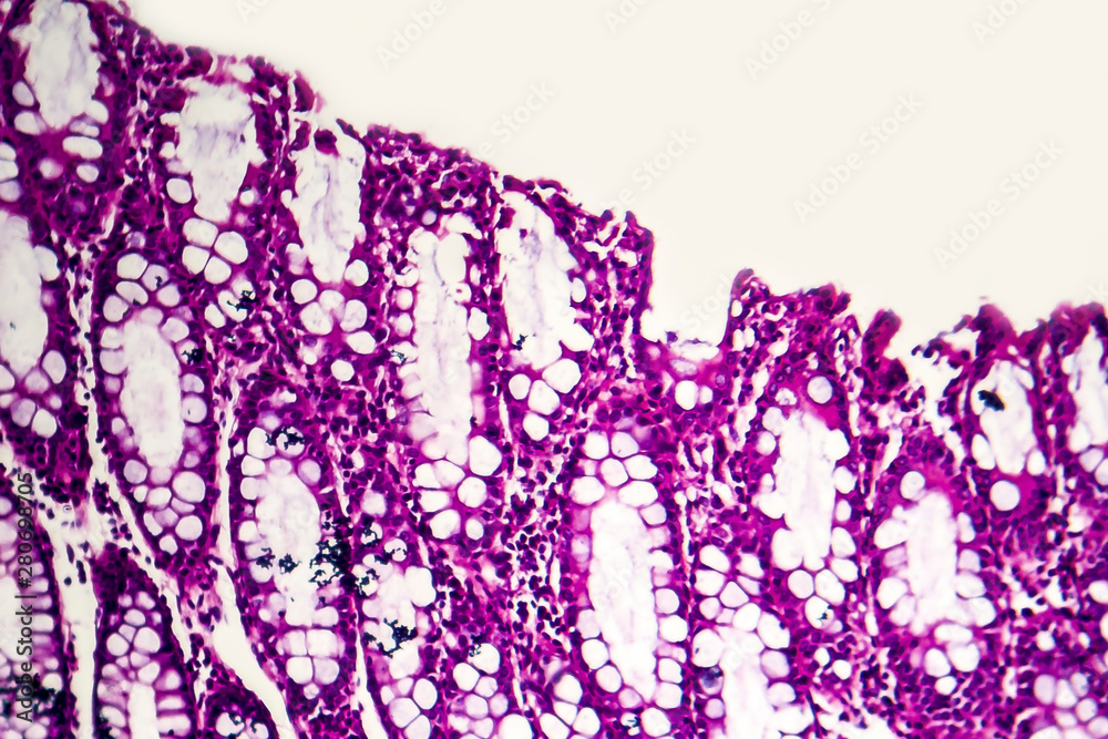 Bacillary dysentery, light micrograph, photo under microscope showing ...