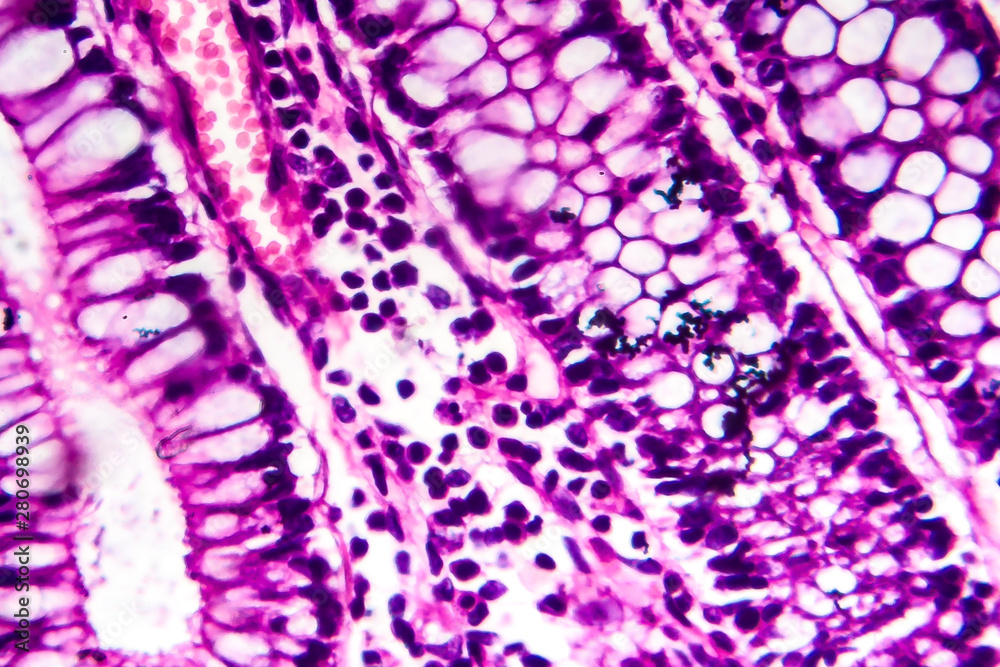 Bacillary dysentery, light micrograph, photo under microscope showing ...