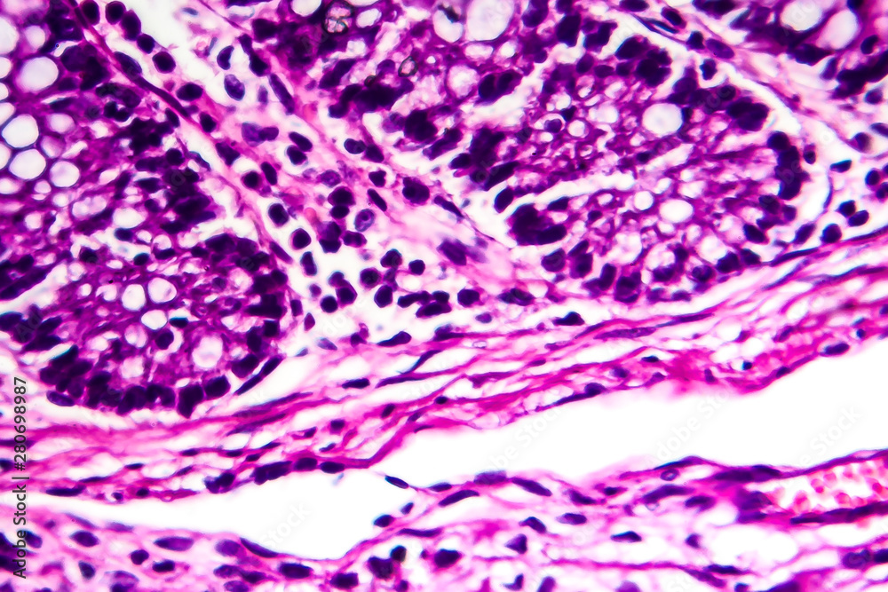 Bacillary dysentery, light micrograph, photo under microscope showing ...