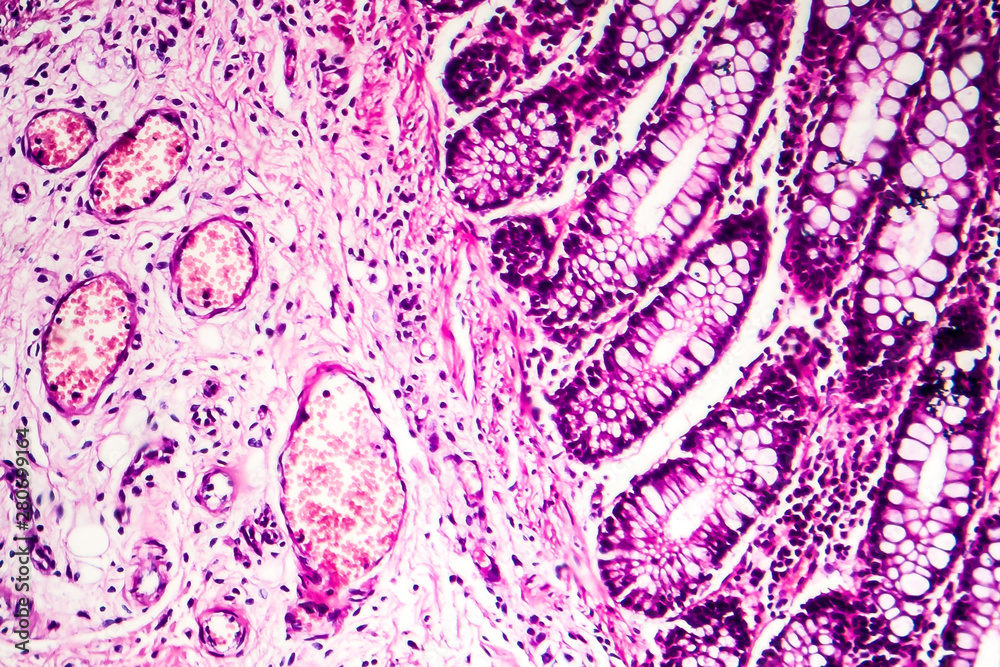 Bacillary dysentery, light micrograph, photo under microscope showing ...