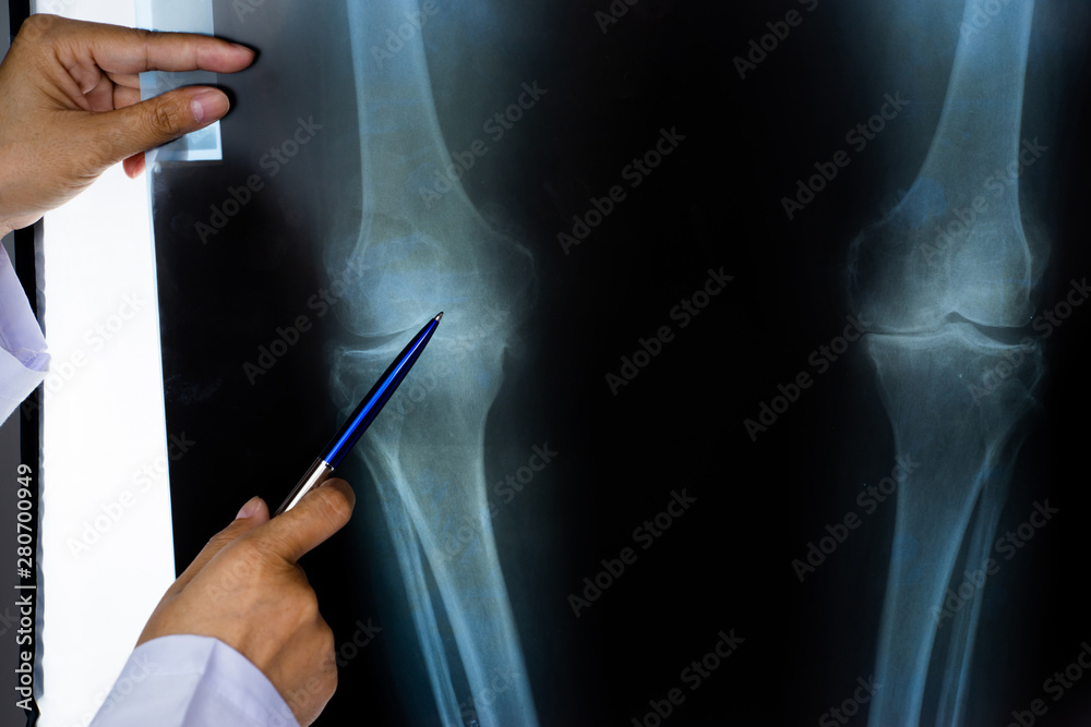 Doctor checking chest x-ray film at ward hospital. Surgery operation ...