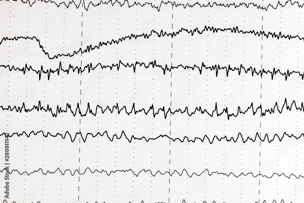 Brain wave patterns on electroencephalogram, EEG of the pediatric ...