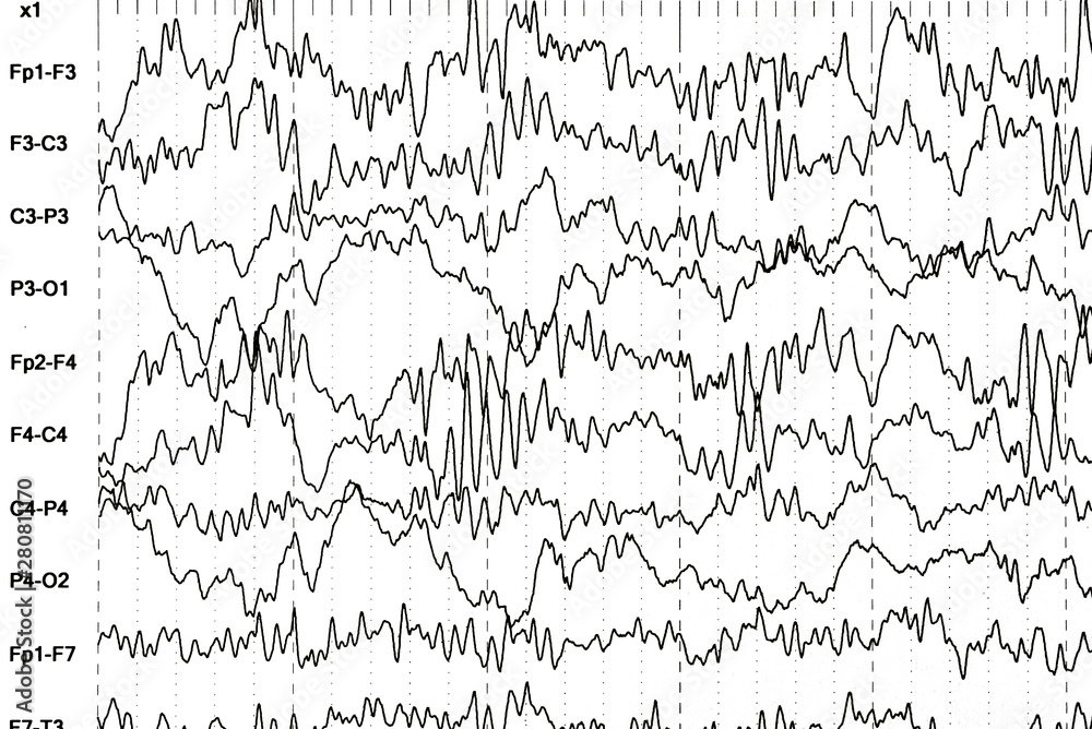 Brain wave patterns on electroencephalogram, EEG of the pediatric ...