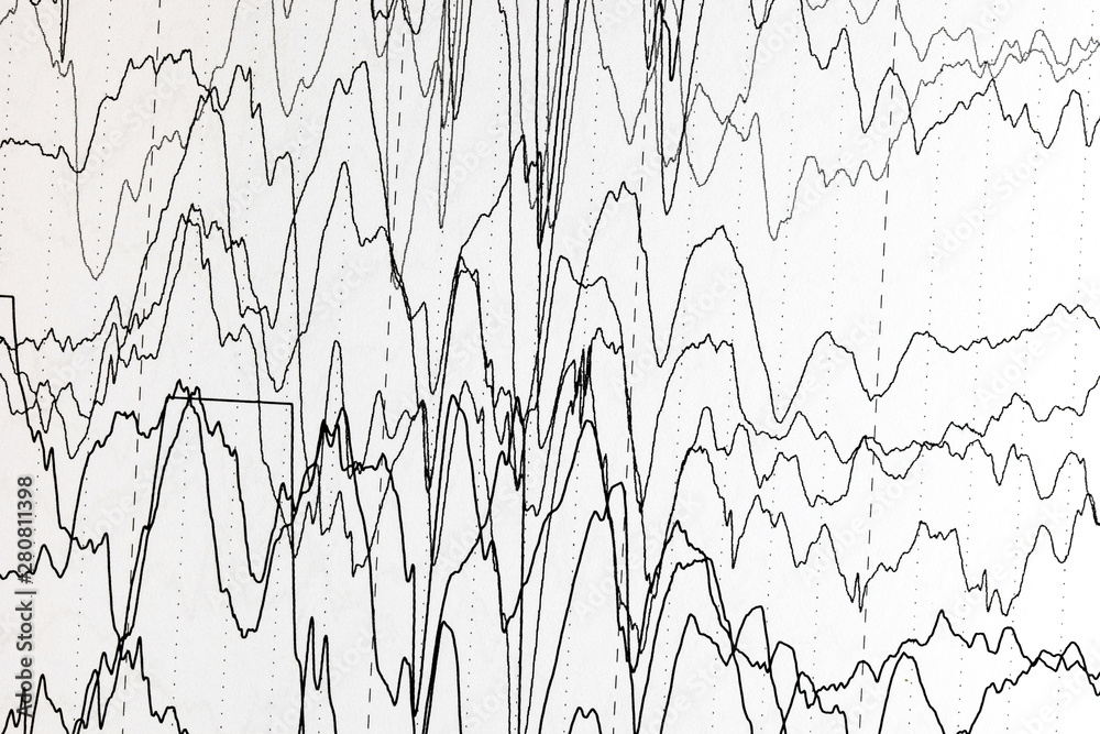 Brain wave patterns on electroencephalogram, EEG of the pediatric ...