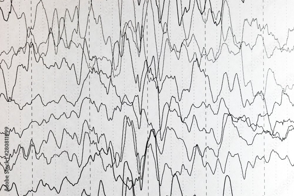Brain wave patterns on electroencephalogram, EEG of the pediatric ...