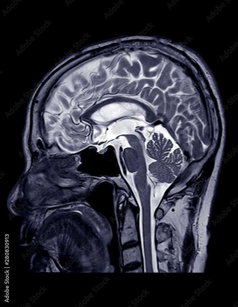MRI of the brain sagittal plane for detect a variety of conditions of ...