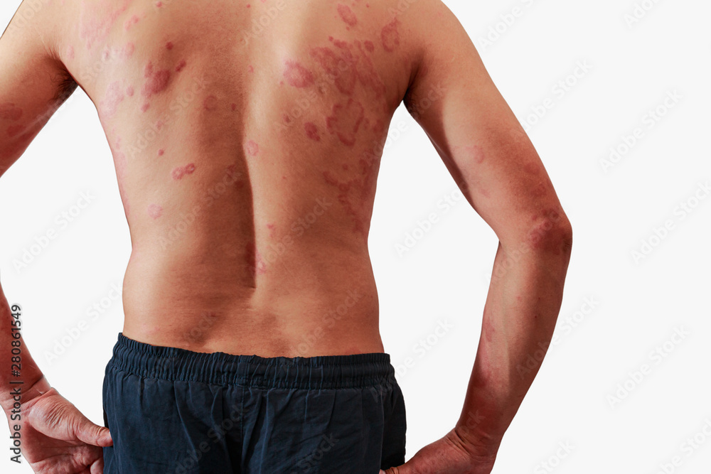 Around Back view of men with dermatitis problem of rash ,Allergy rash ...
