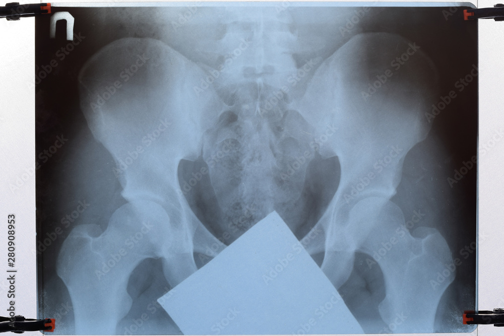 X-ray of the pelvis and sacrum. X-ray Stock Photo | Adobe Stock
