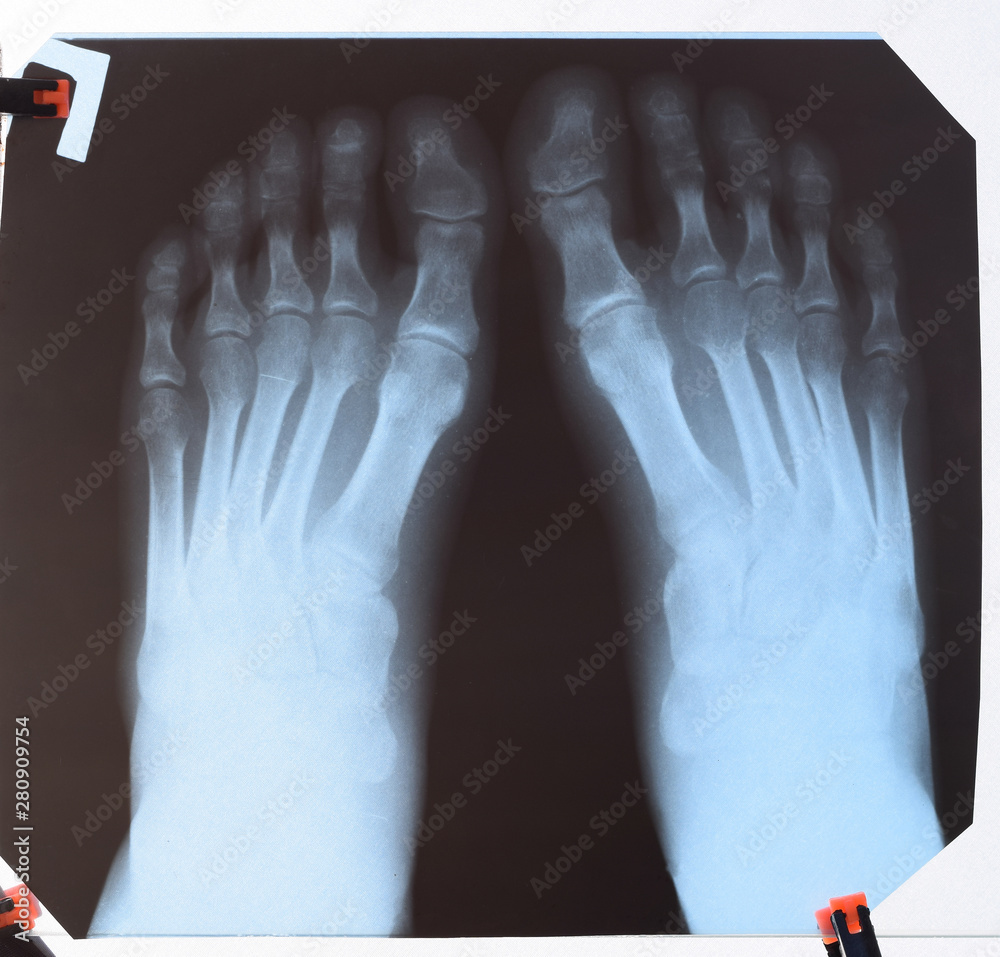 X-ray of toes. Foot on Xray. bone research Stock Photo | Adobe Stock