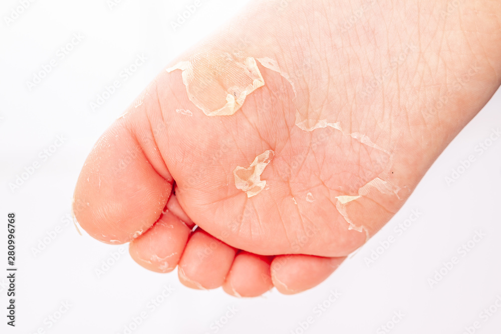 Foto de After the red rash and the strawberry tongue caused by scarlet ...