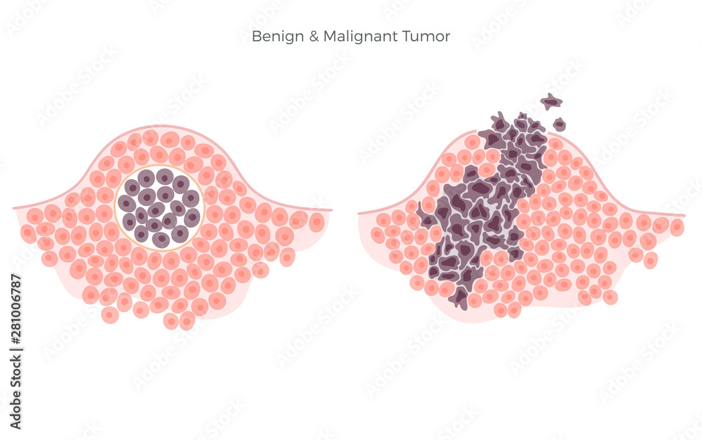 Vector illustration of malignant and benign tumor Stock Vector | Adobe ...