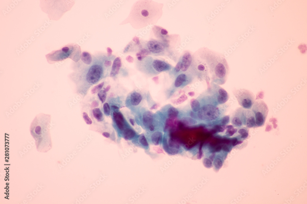 View in microscopic of abnormal human cervix cells.Squamous metaplasia ...