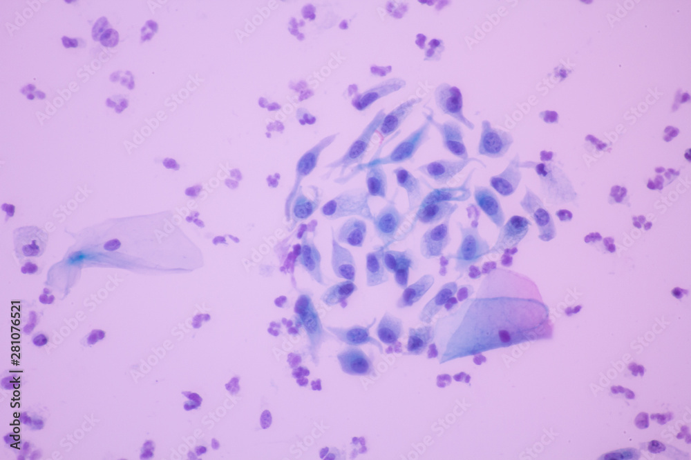 View in microscopic of abnormal human cervix cells.Squamous epithelium ...