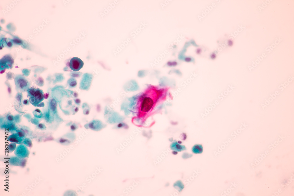 View in microscopic of abnormal body fluid cells.Squamous epithelium ...