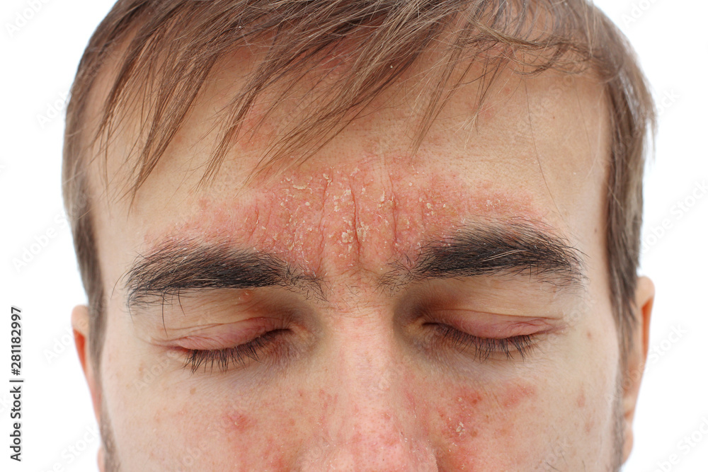 head of sick man with closed eyes with red allergic reaction on skin ...