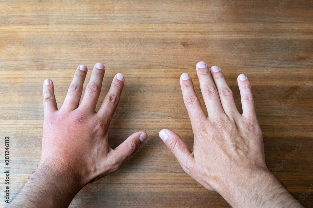 Comparison of two male hands stung by bee or wasp. Hand swelling ...