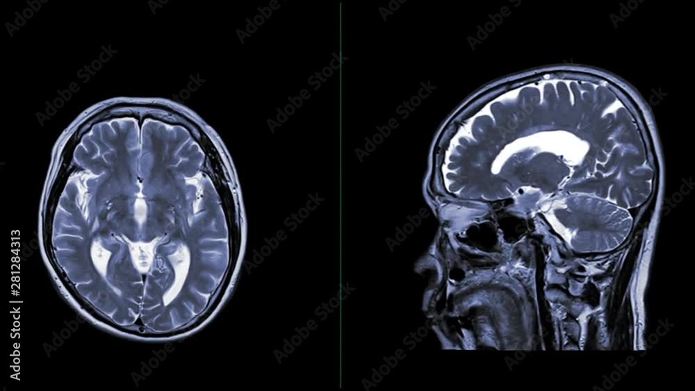 MRI of the brain axial and sagittal plane for detect Brain disease ...