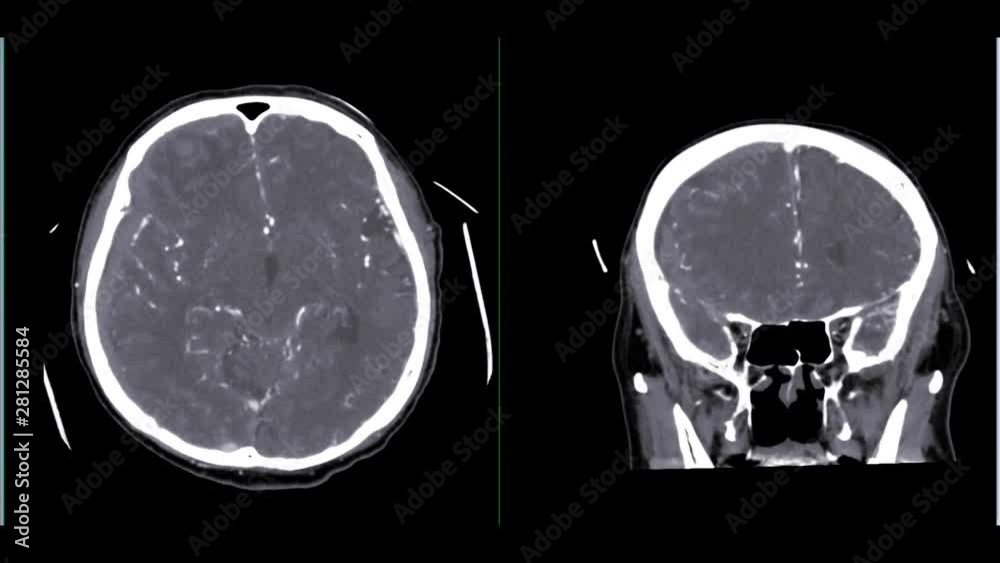 CTA brain comparison Axial and coronal plane showing subdural ...