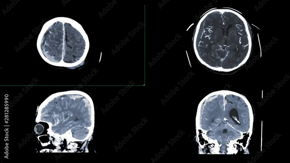 CTA brain comparison Axial,sagittal and coronal plane showing subdural ...