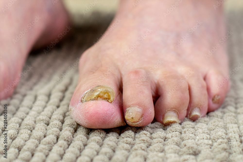 Nail fungus. Nail fungus on legs. Nail disease.Toenail fungus ...