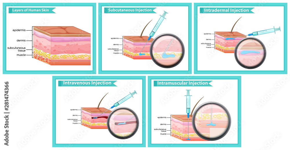 Scientific medical illustration of types of injections Stock Vector ...