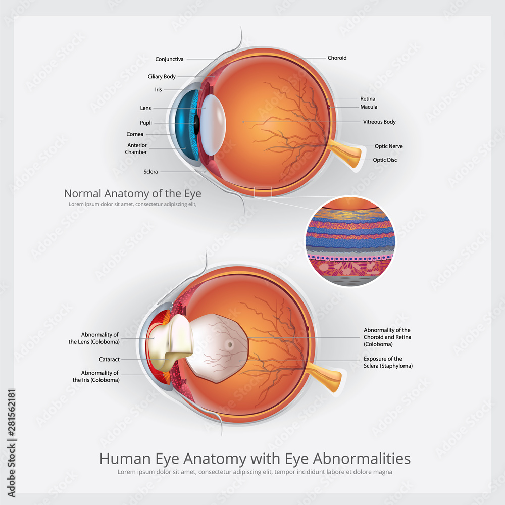 Eye Anatomy with Eye Abnormalities Vector Illustration Stock Vector ...