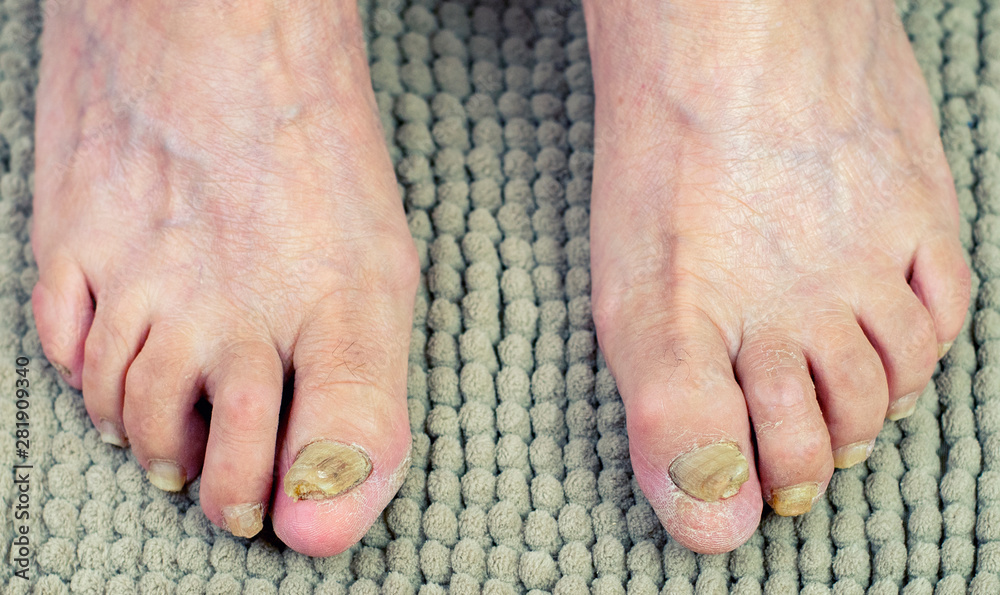 Nail fungus. Nail fungus on legs. Nail disease.Toenail fungus ...