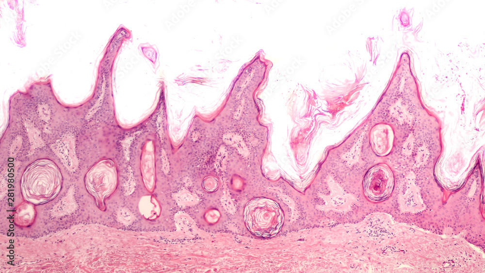 Skin biopsy of a seborrheic keratosis with frequent horn cysts. Stock ...
