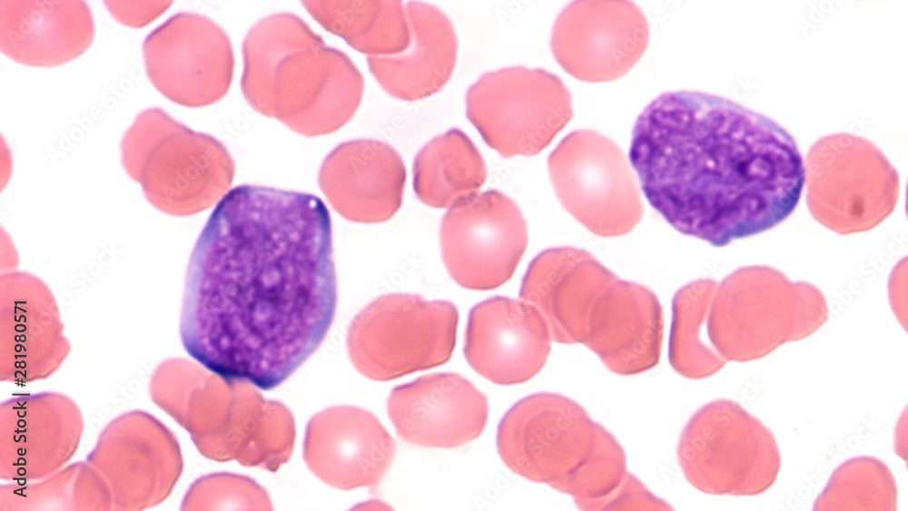Microscopic image (photomicrograph) of a peripheral blood smear in a patient with acute ...