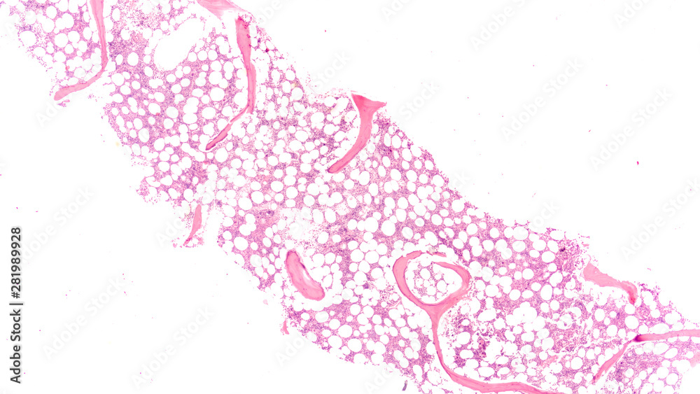 Photomicrograph showing histology a bone marrow biopsy, with cellular ...