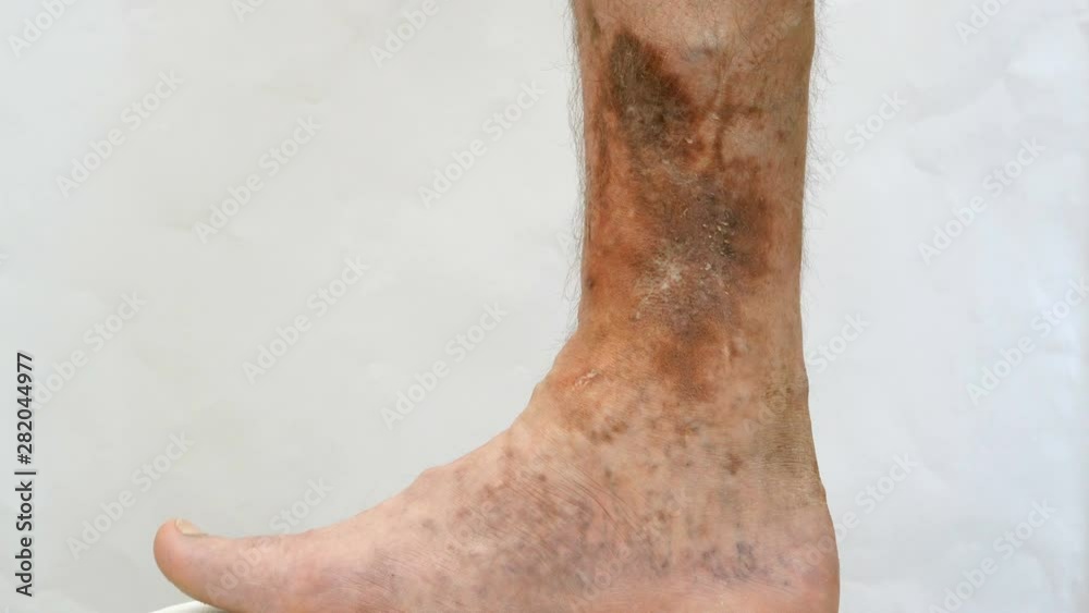 Human skin disease. Person s foot that is affected by dermatological ...