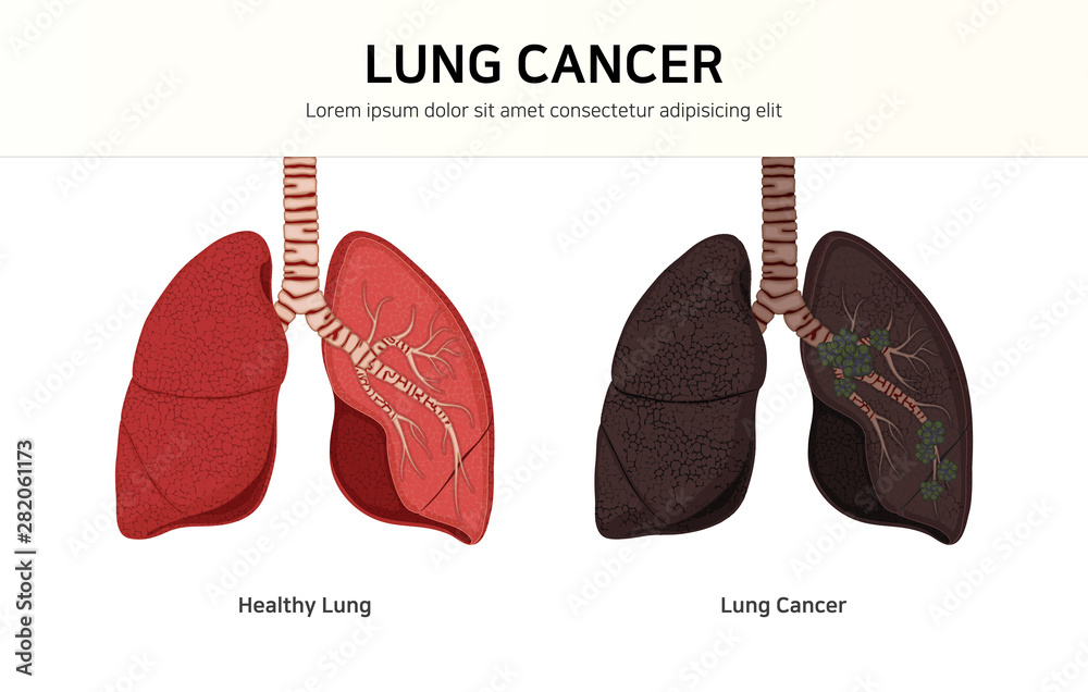 healthy lung and lung cancer. Normal lung vs Lung cancer Stock Vector ...