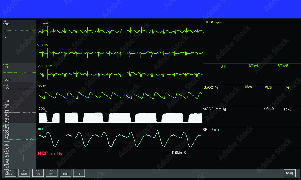 Monitoring graph displays of patient vital signs of intensive care unit ...