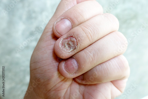 Ringworm On Nails