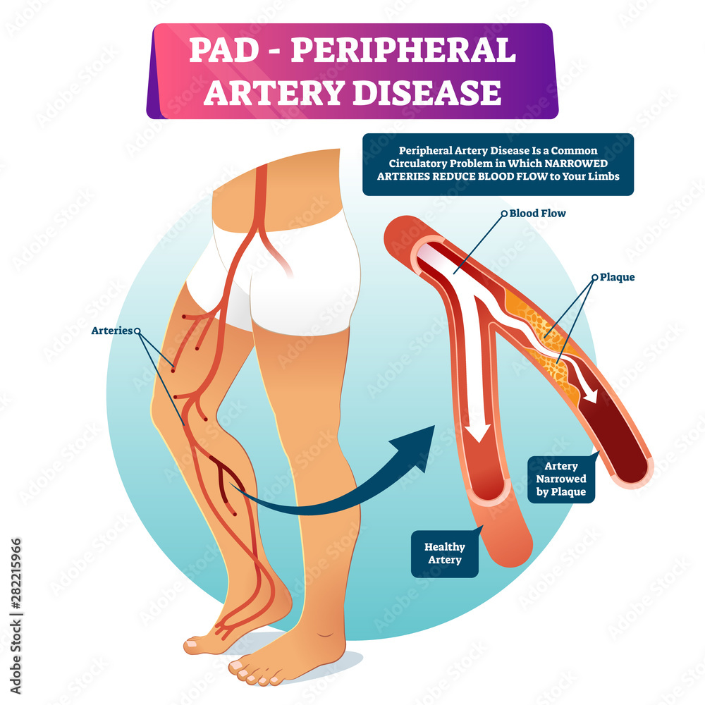 Peripheral artery disease PAD vector illustration. Labeled medical ...