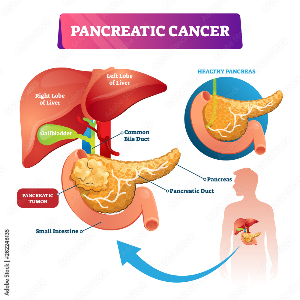 Pancreatic cancer vector illustration. Labeled ill stomach oncology ...