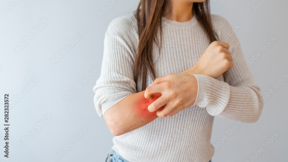 Health allergy skin care problem. Closeup young woman scratching her ...