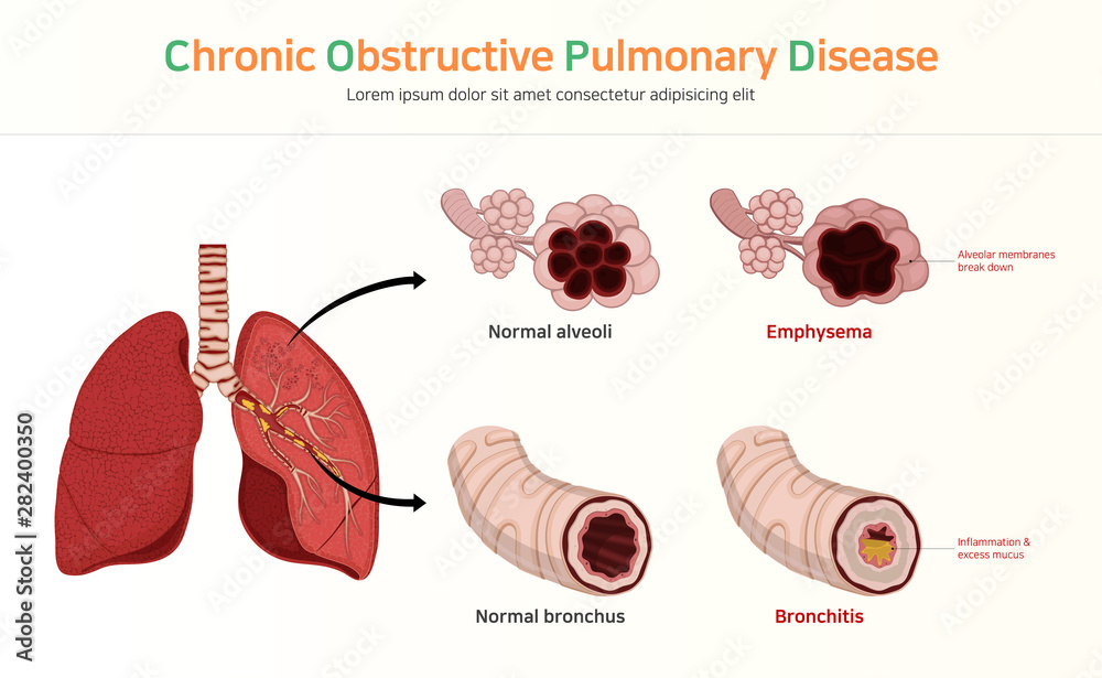 COPD (Chronic Obstructive Pulmonary Disease) Stock Vector | Adobe Stock